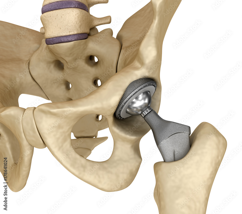 Hip replacement implant installed in the pelvis bone. Medically ...