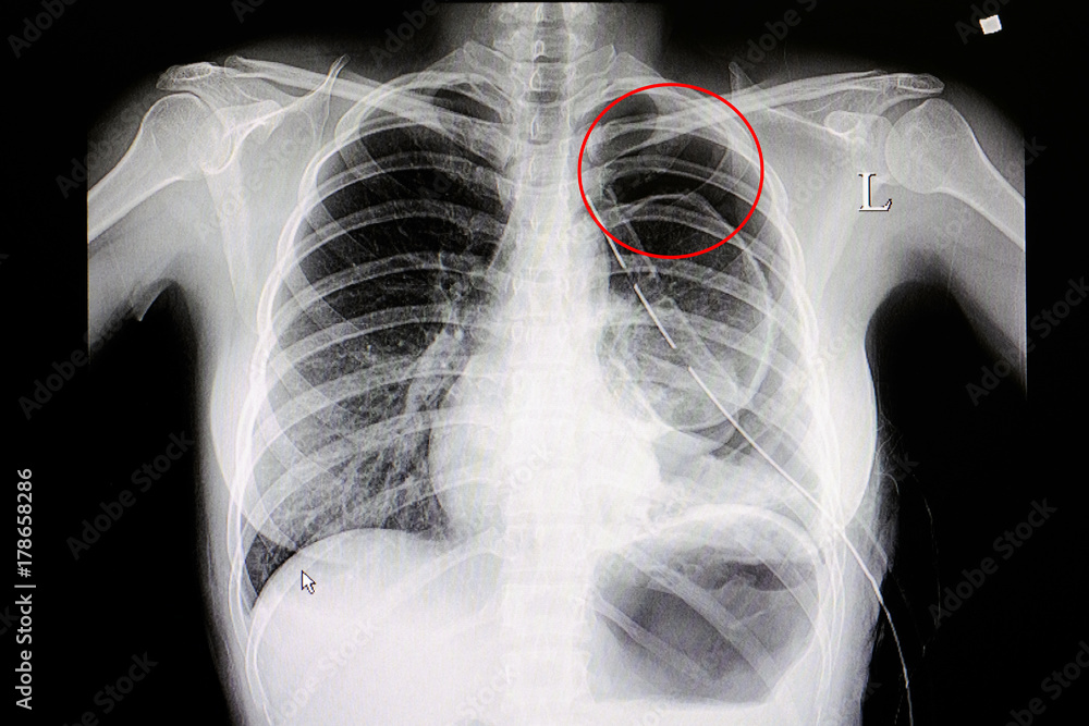 Chest x-ray film of patient with Pneumothorax Stock Photo | Adobe Stock