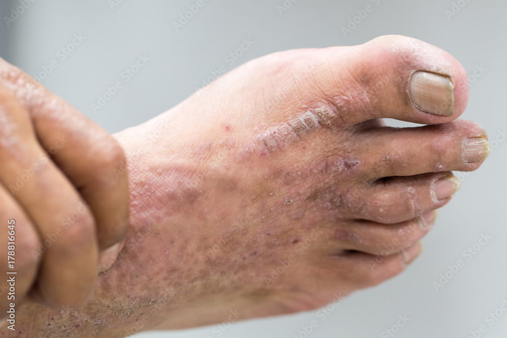 Atopic dermatitis (AD), also known as atopic eczema, is a type of ...