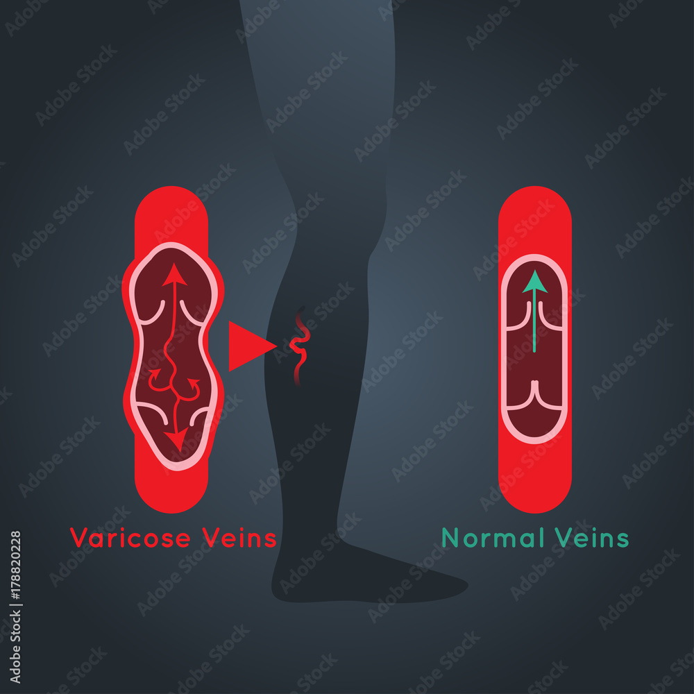 Varicose Veins vector logo icon illustration Stock Vector | Adobe Stock