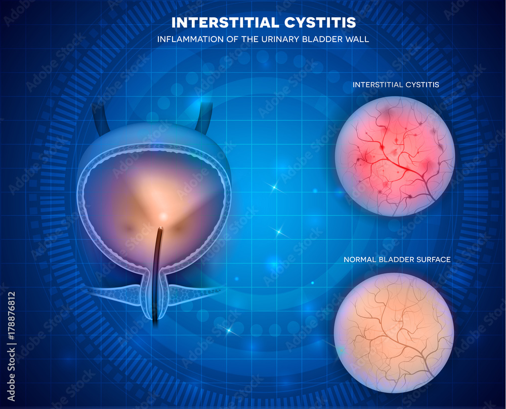 Urinary bladder surface examination with Cystoscope closeup of healthy ...