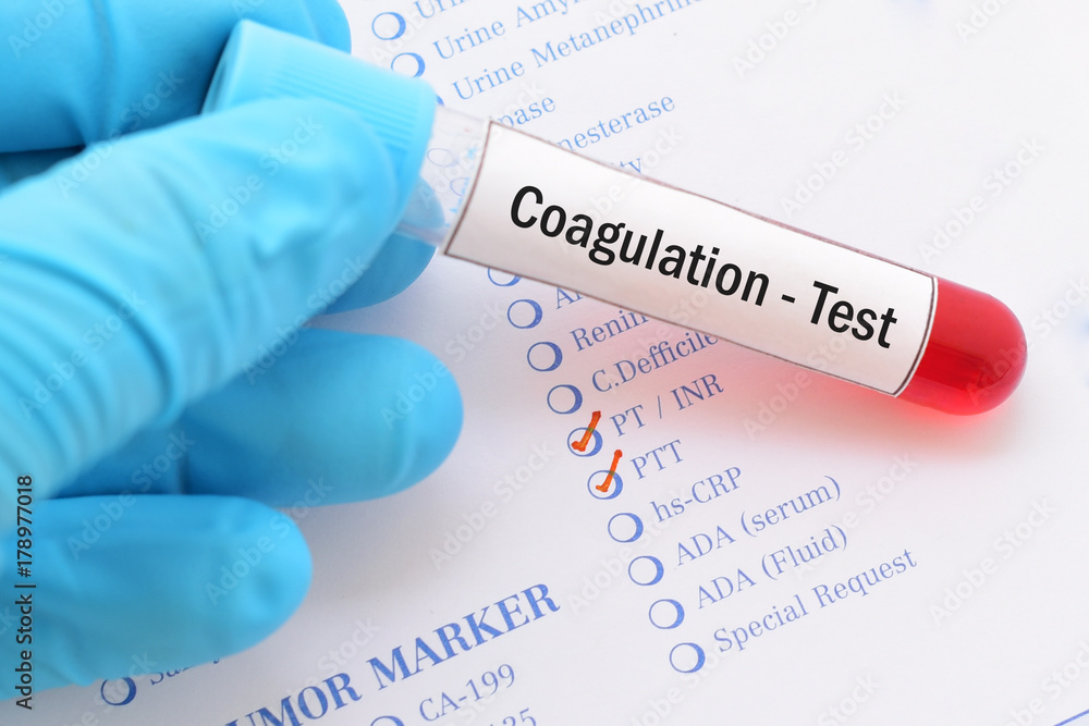 Blood sample with requisition form for coagulation test Stock Photo ...