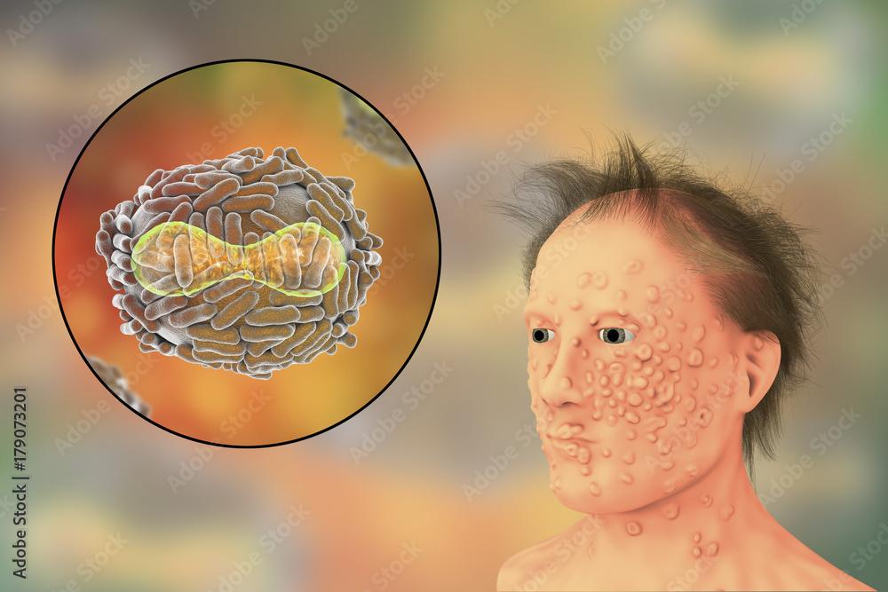 A man with smallpox infection and variola virus, a virus from ...