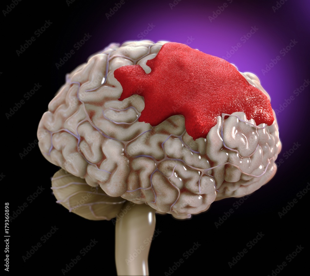 Illustration of human brain hemorrhage against black background Stock ...