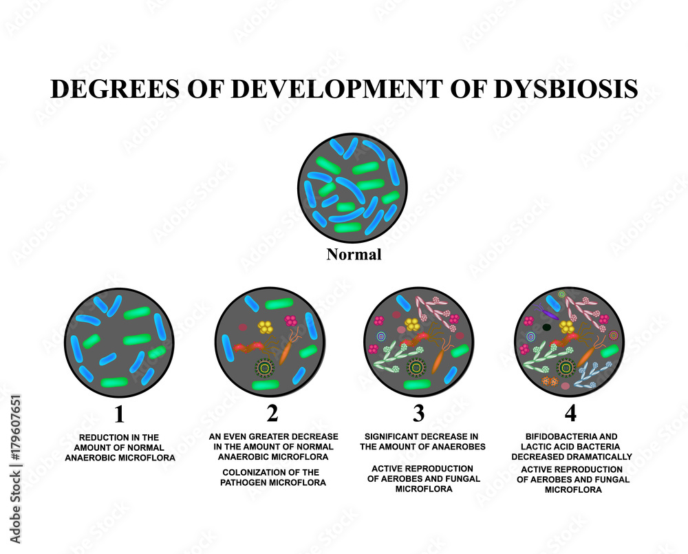 4 degrees of development of dysbiosis. Dysbacteriosis of the intestine ...