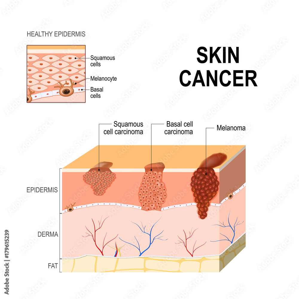 Skin Cancer Squamous Cell Carcinoma Basal Cell Cancer And Melanoma