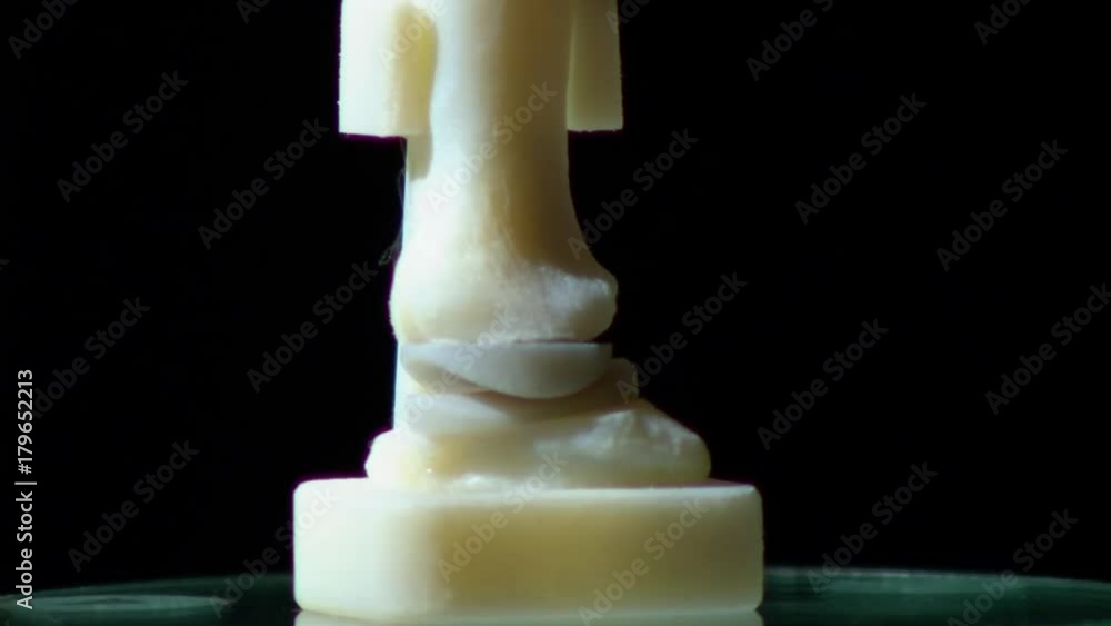 Prosthesis for the metacarpal bone printed in 3D. Quervain syndrome ...