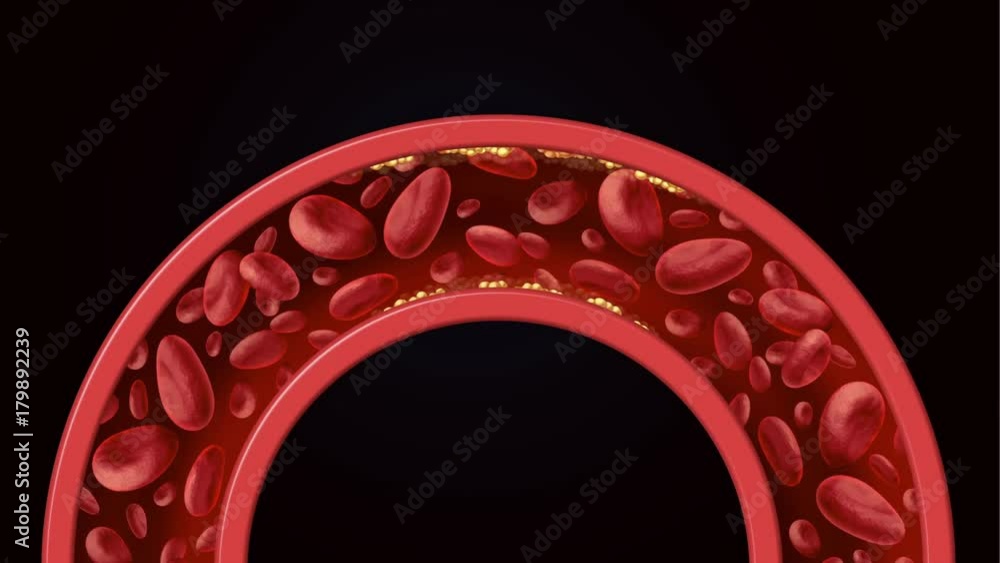 Coronary artery disease medical concept as a circular vein with gradual ...