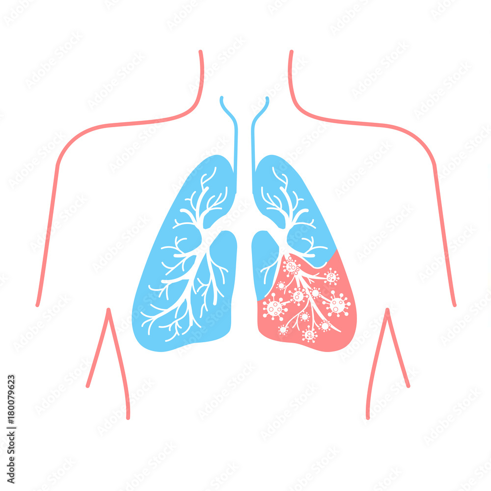 icon of lung disease pneumonia Stock Vector | Adobe Stock