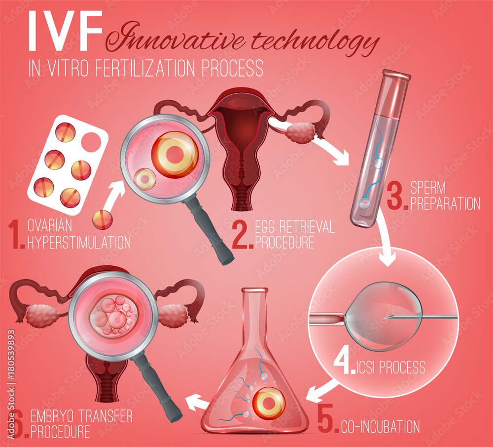 In Vitro Fertilization Stock Vector | Adobe Stock