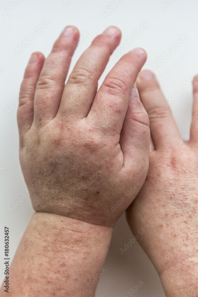 Scarlet fever. Two children's hands with rash on white background ...