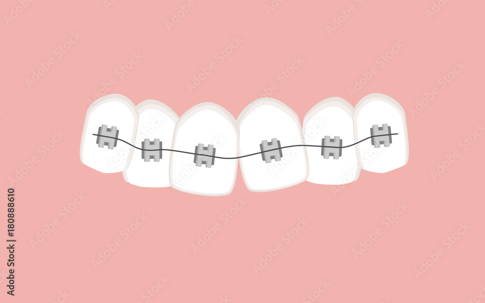 Vector image of the stages of orthodontic treatment (braces on teeth ...