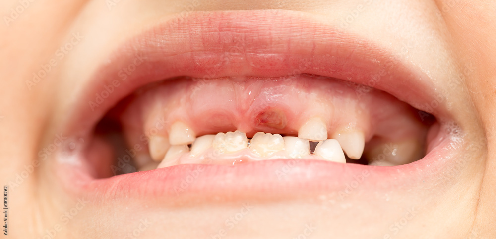 Foto Stock Open mouth boy without teeth | Adobe Stock