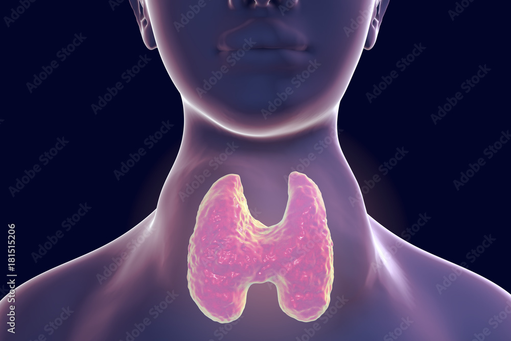 Toxic diffuse goiter, Flajani-Basedow-Graves' disease. 3D illustration ...