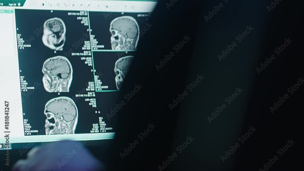 Reveal Multiple MRI Head Scans on Laptop Pan Left. view pans left and ...