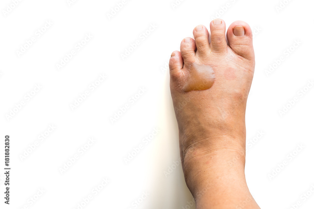 The Scald On The Foot Skin Caused By The Boiling Cooking Oil Stock the-scald-on-the-foot-skin-caused-by-the-boiling-cooking-oil-stock