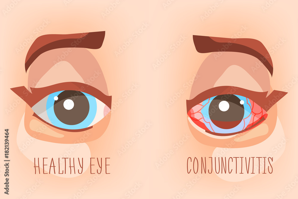 Sick eyes, eye conjunctivitis. Eyecare illustration, healthy and ...