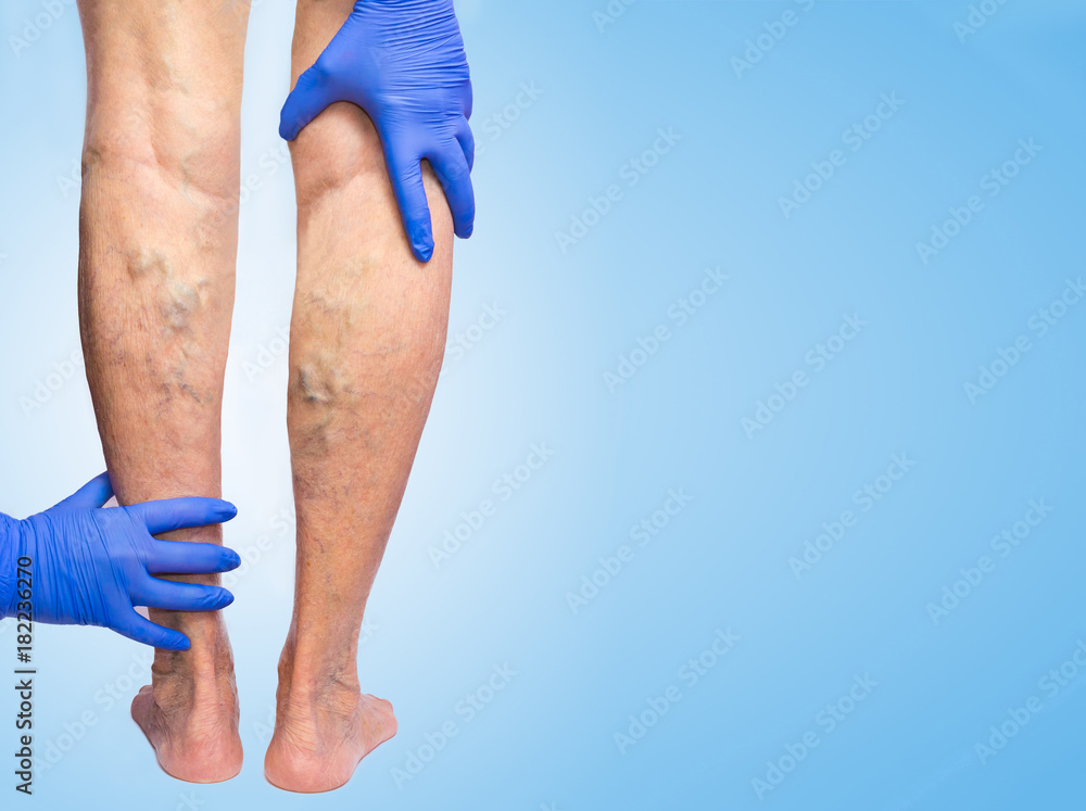Lower limb vascular examination because suspect of venous insufficiency ...