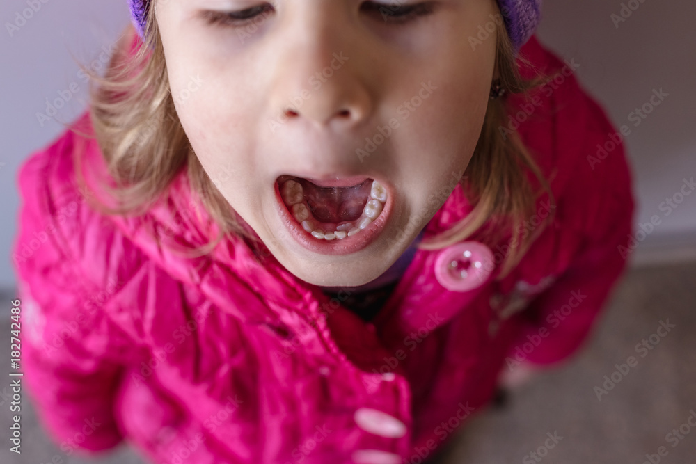 Foto de Adult permanent teeth coming in behind baby teeth: shark teeth ...