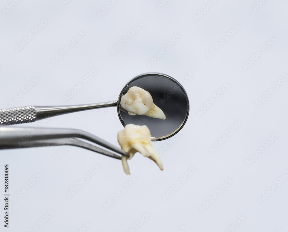 bad rotten tooth pulled out with metal forceps and is reflected in the ...