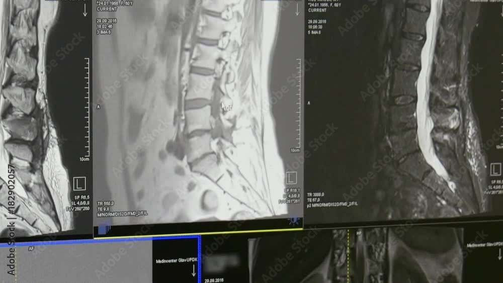 Spinal cord and spinal column tomography on MRI scan. Diagnosis of a ...