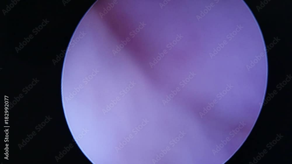 Female neck of uterus womb cervix uteri on monitor gynecological ...