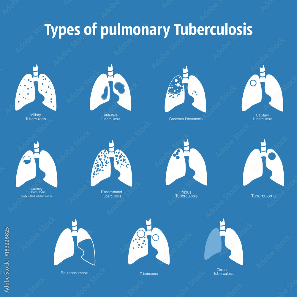 Types of tuberculosis. Vector silhouette medical illustration of human ...