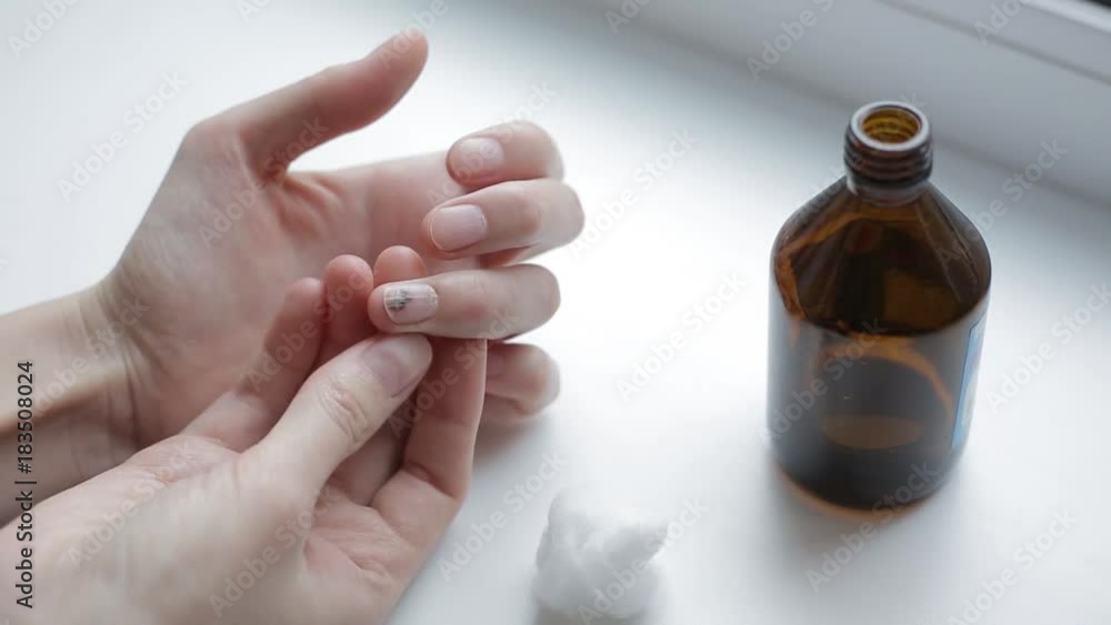 Trauma of toenail. Subungual hematoma. Bruise under the nail of big toe ...