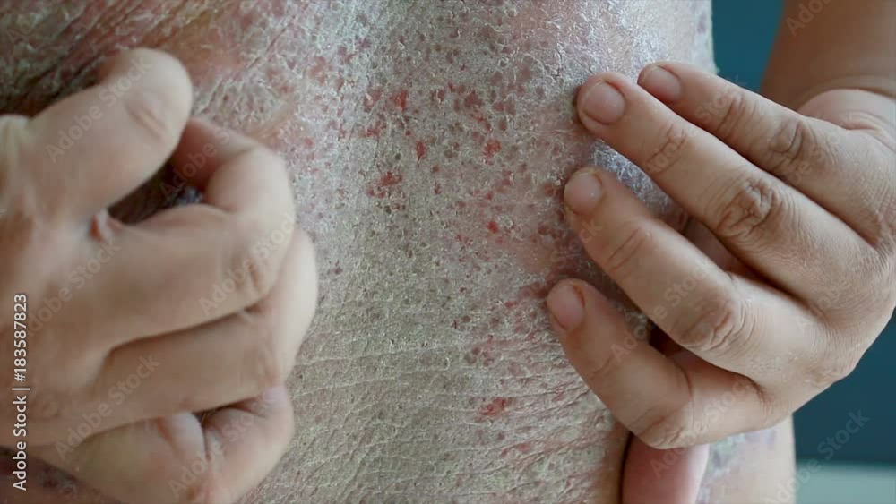 4K Close up shot hands of man scratching skin rash Dermatitis psoriasis ...