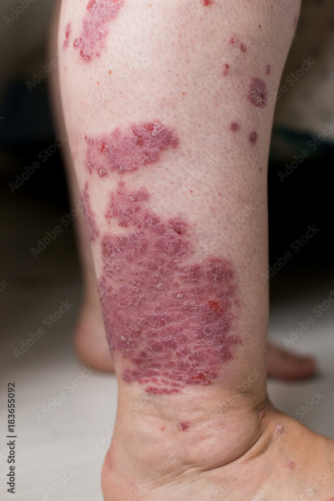 One Caucasian woman with psoriasis, eczema, atopic dermatitis on the ...