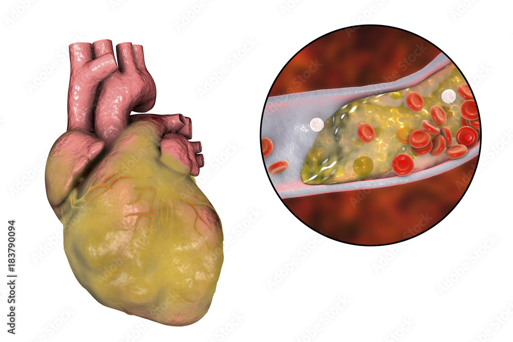Obese heart and closeup view of coronary artery with cholesterol plaque ...