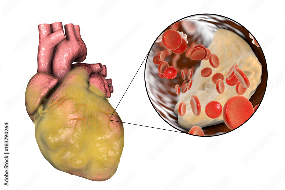 Obese heart and closeup view of coronary artery with cholesterol plaque ...