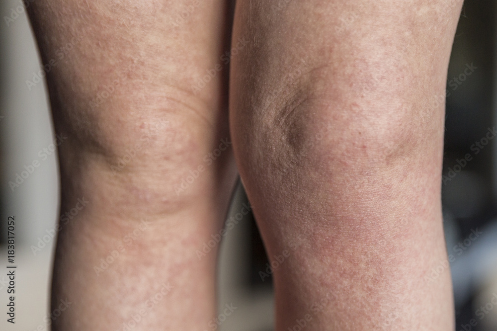 Scarlet fever. Children's legs with rash inside background. Stock Photo ...