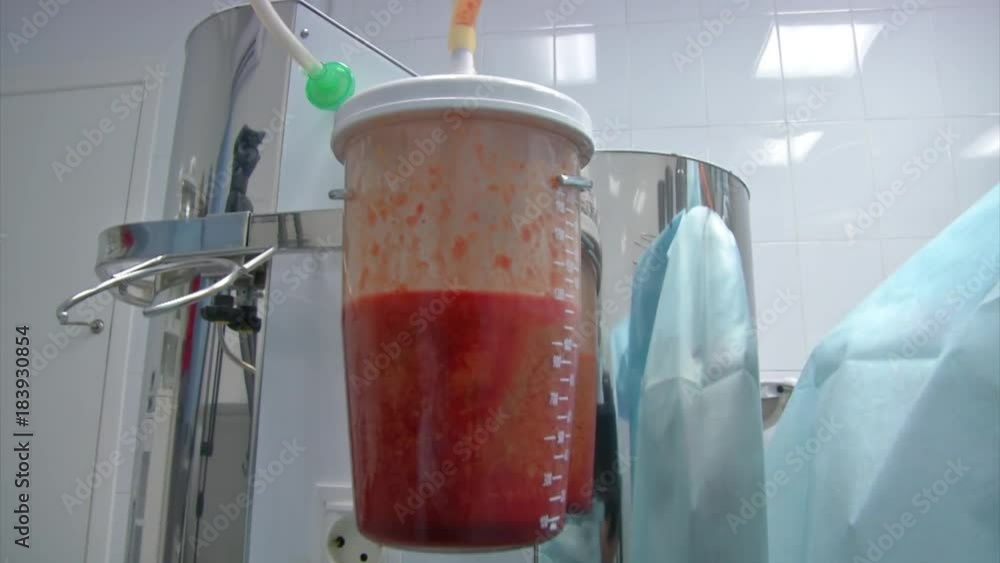 Partial removal of fat and mucous tissues. Fat liquid in the bottle ...