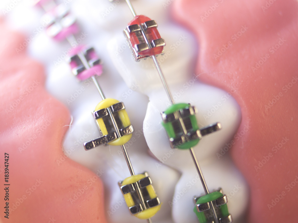 Cosmetic dental metal brackets Stock Photo | Adobe Stock