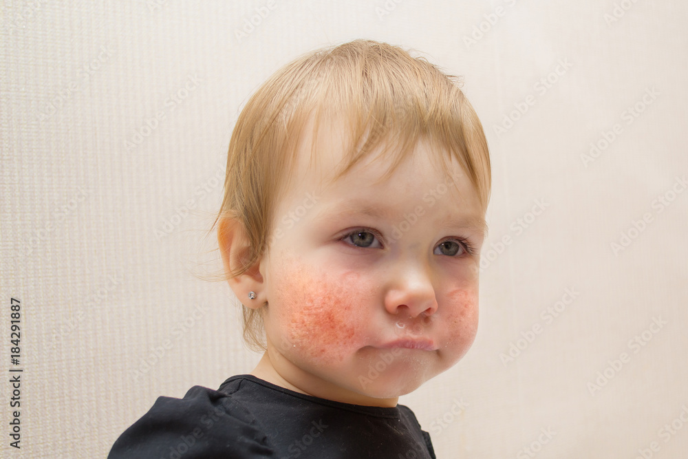 Cute child 1 - 2 years old with eczema or allergic rash on his face ...