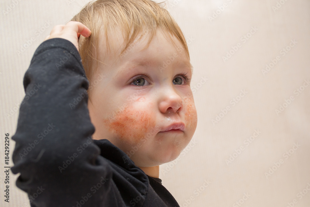 Cute child 1 - 2 years old with eczema or allergic rash on his face ...