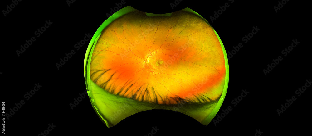 eye's retinal angle image with macula, vessels and optic disc isolated ...