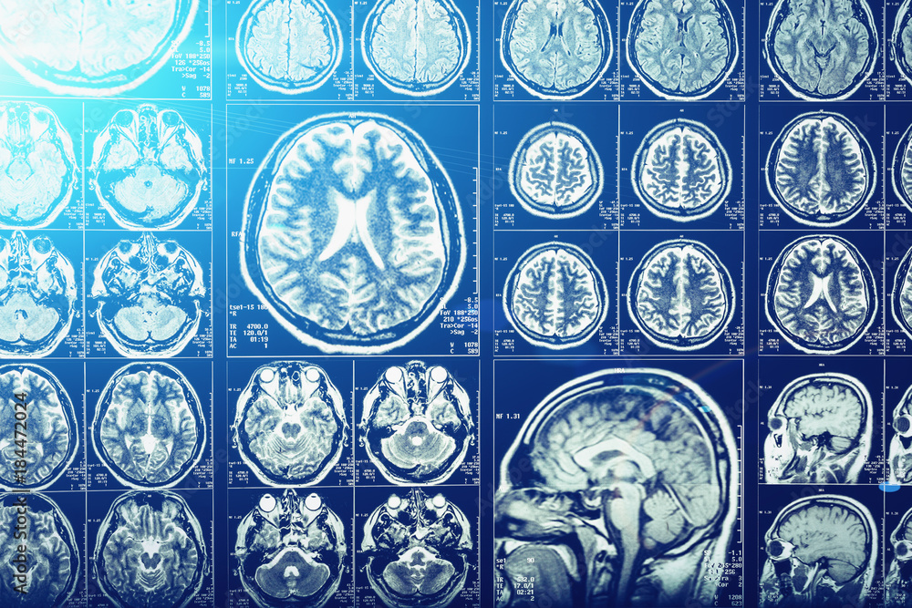 Computer head tomography, X-Ray brain or scull scan image, blue light ...