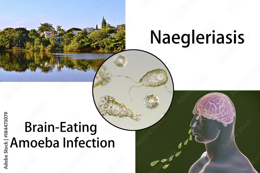Brain-eating amoeba infection, naegleriasis. Image shows water ...