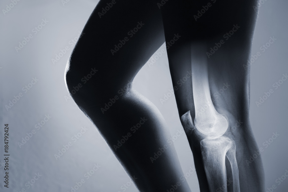 Human knee joint and leg in x-ray Stock Photo | Adobe Stock