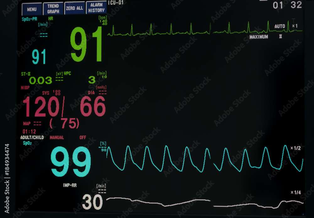 Monitor Vital Sign And EKG Monitor In ICU Unit it Show The Waves Of Monitor Vital Sign And EKG Monitor In ICU Unit it Show The Waves Of