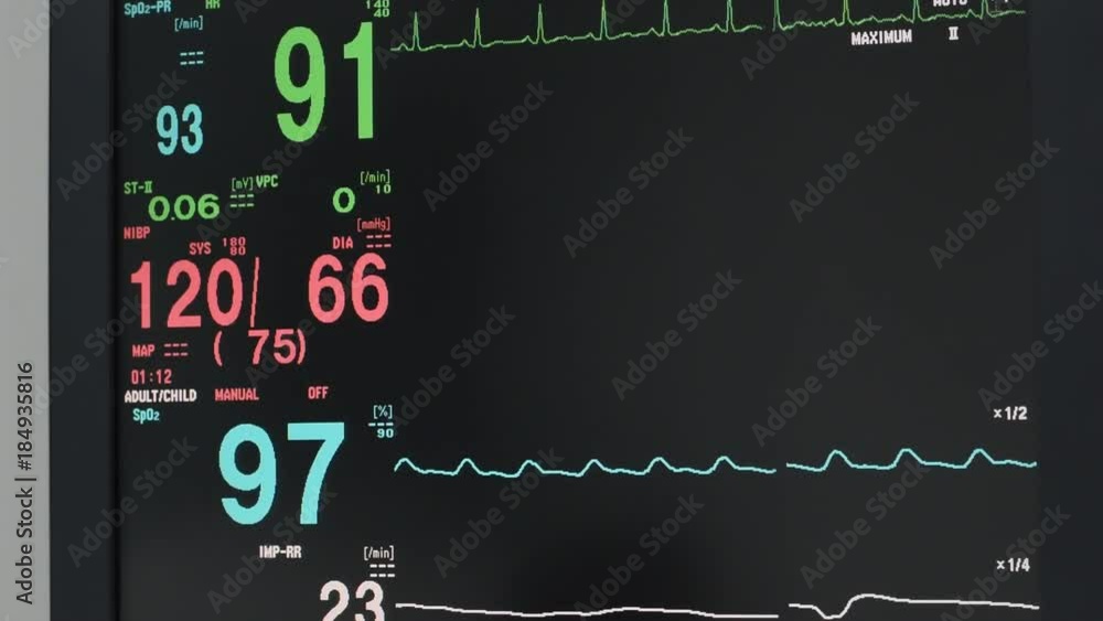 Monitor vital sign and EKG monitor in ICU unit ,it show The waves of ...