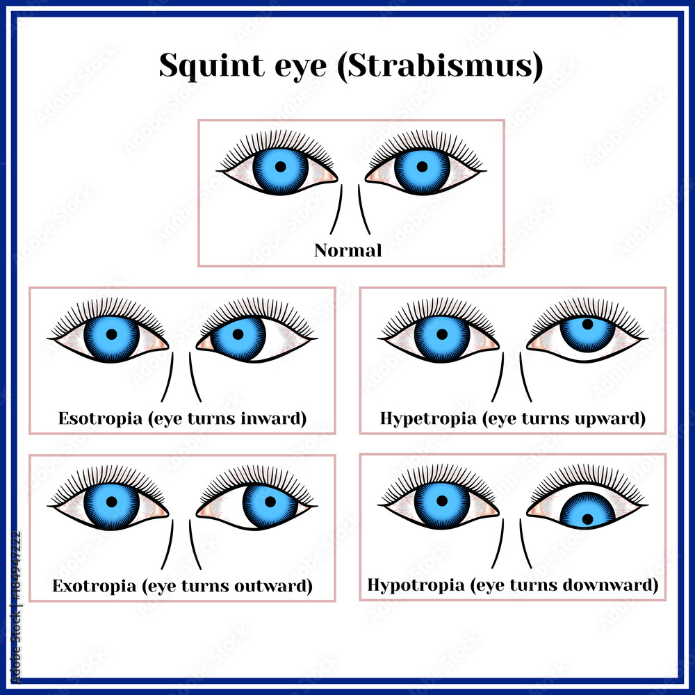 Squint eye (Strabismus). Deflection of visual axes. Stock Vector ...