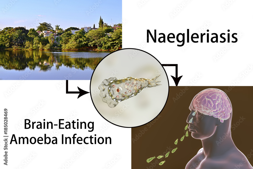 Brain-eating amoeba infection, naegleriasis. Image shows water ...