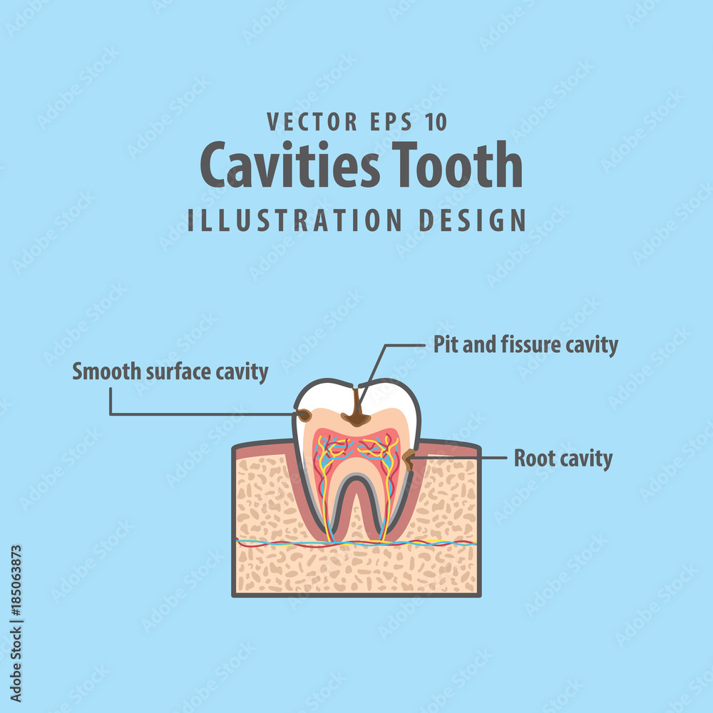Cavitys tooth cross-section structure inside tooth diagram and chart ...