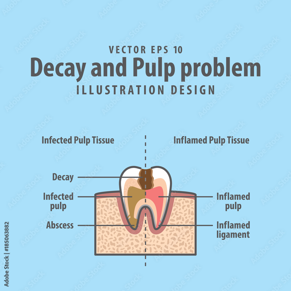 Decay and Pulp problem cross-section structure inside tooth diagram and ...