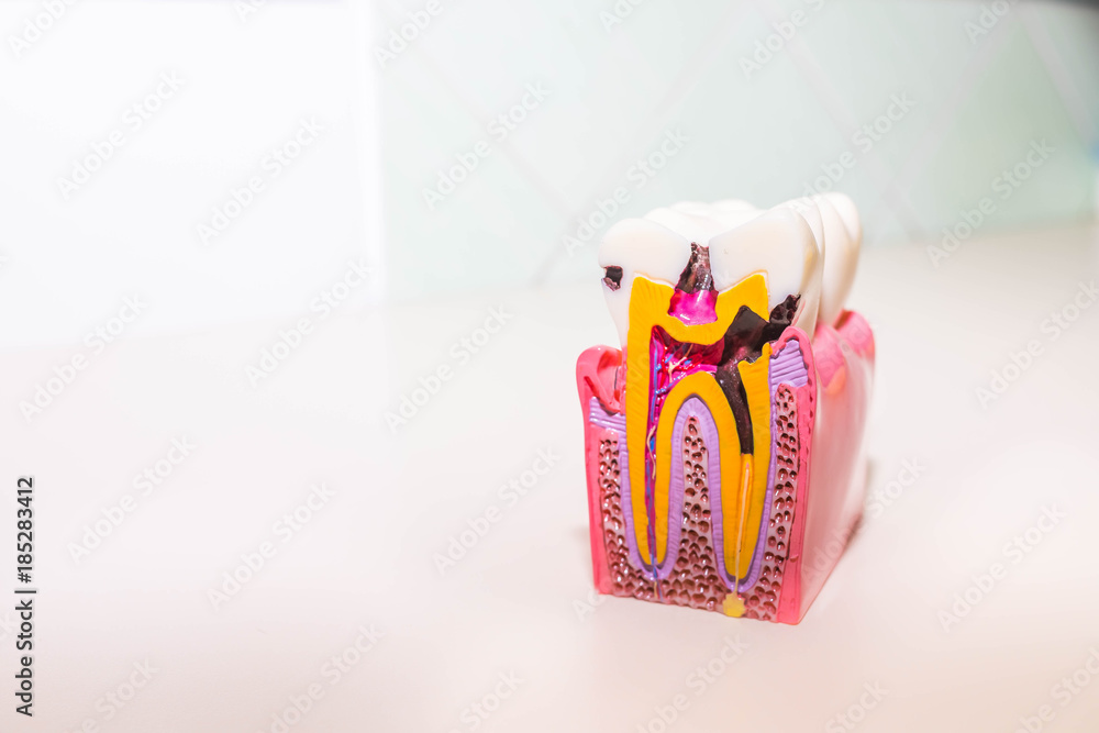 tooth model with caries, tooth decay in dentist's office. Healthy teeth ...