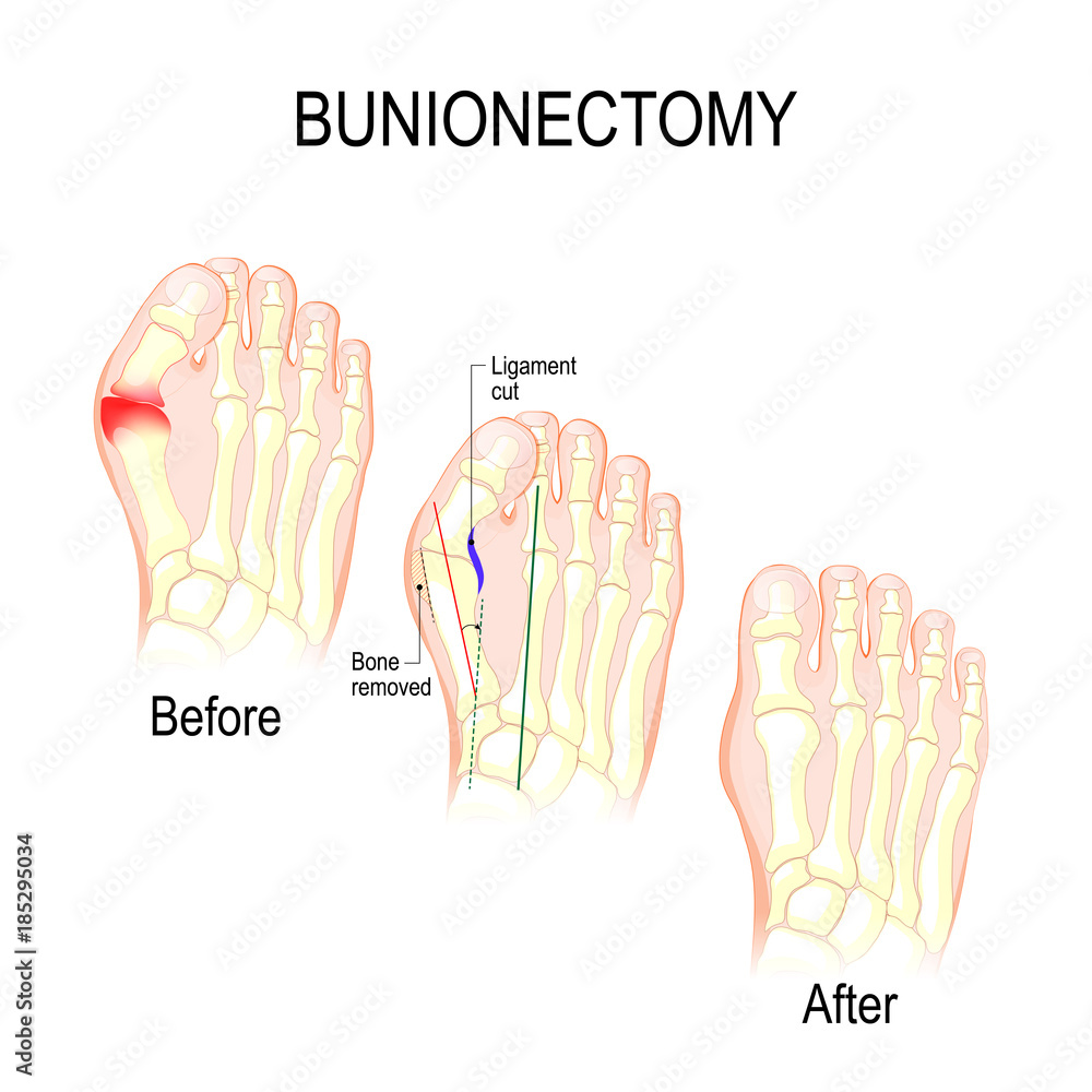 Bunionectomy. surgery to correct pathologies of the foot. Stock Vector ...