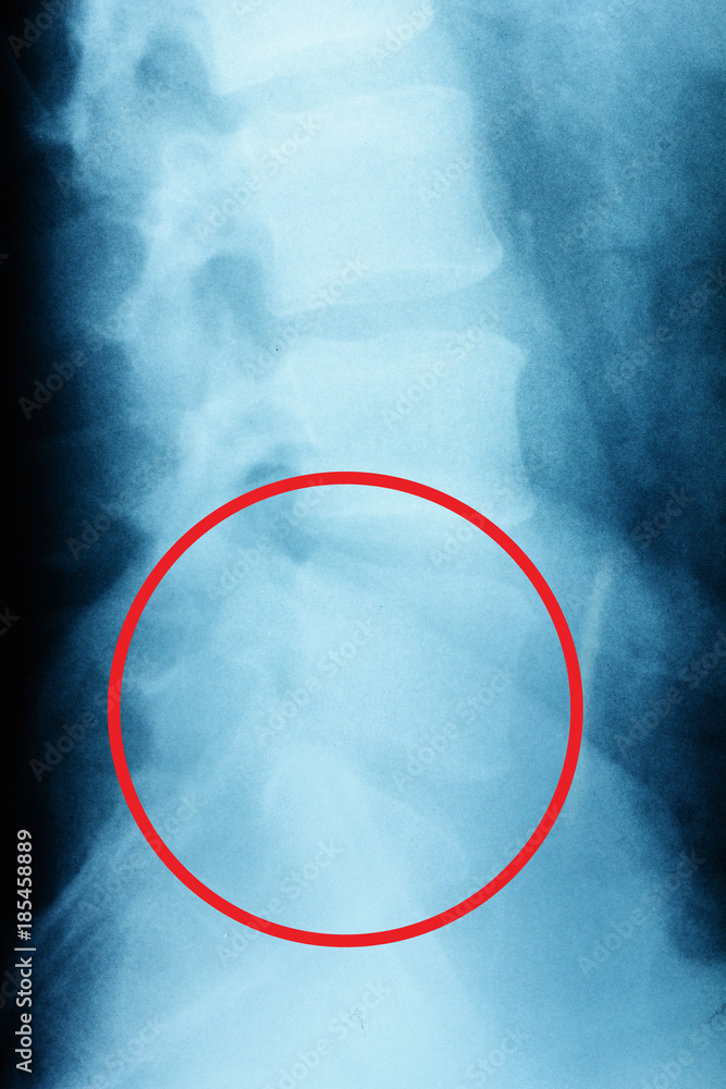Film x-ray lumbar spine , L-S spine AP,Lateral view Grade ...
